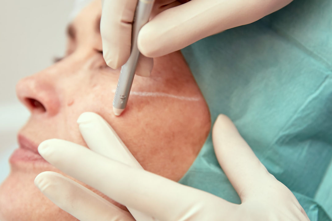 Thread Lift - Auckland Cosmetic Medicine